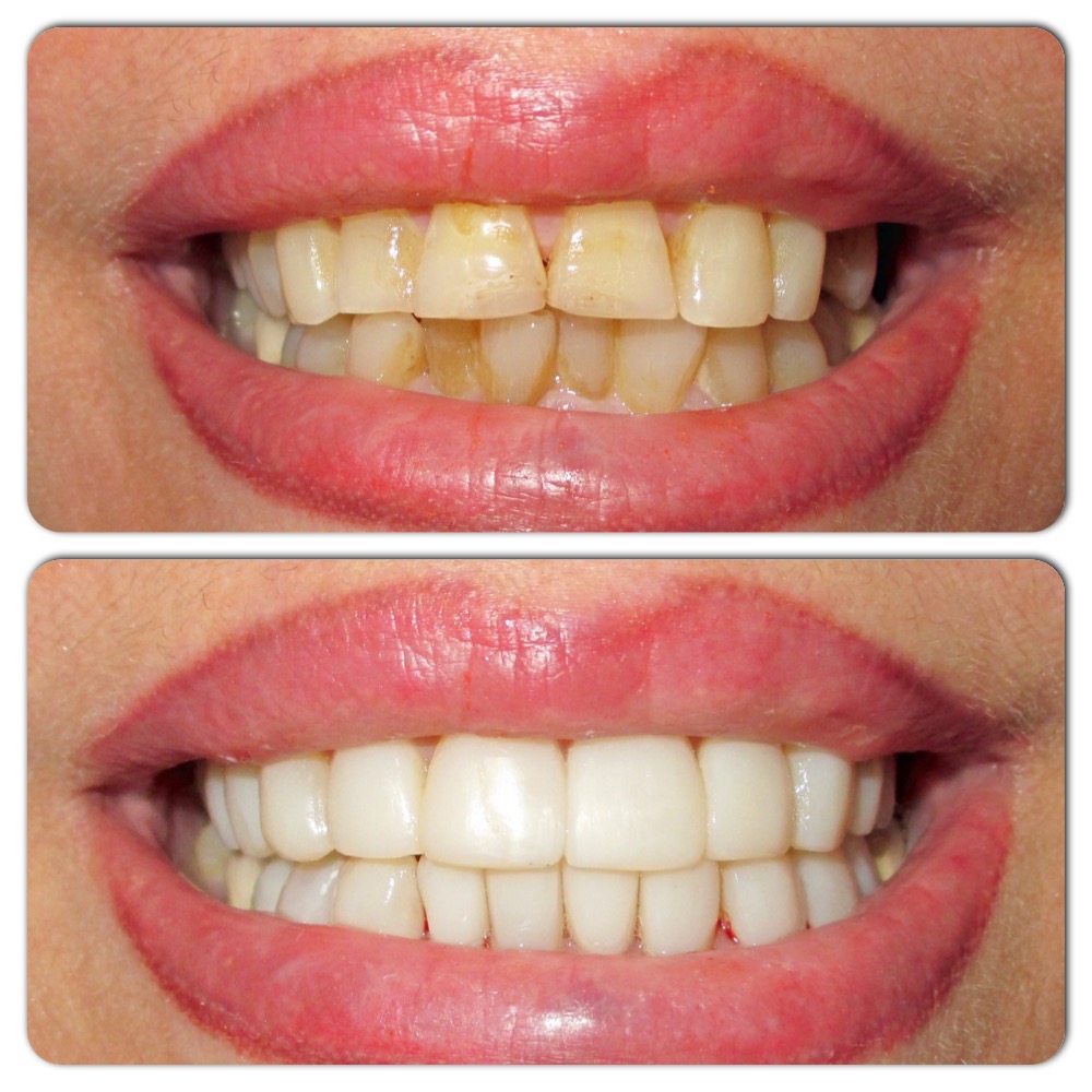 Before & After work done by Our Doctor’s - Centre Dental